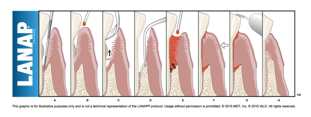 LANAP/LAPIP Laser Treatment Burbank, CA | Burbank Periodontics
