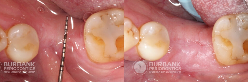 Ridge Augmentation | Burbank Periodontics