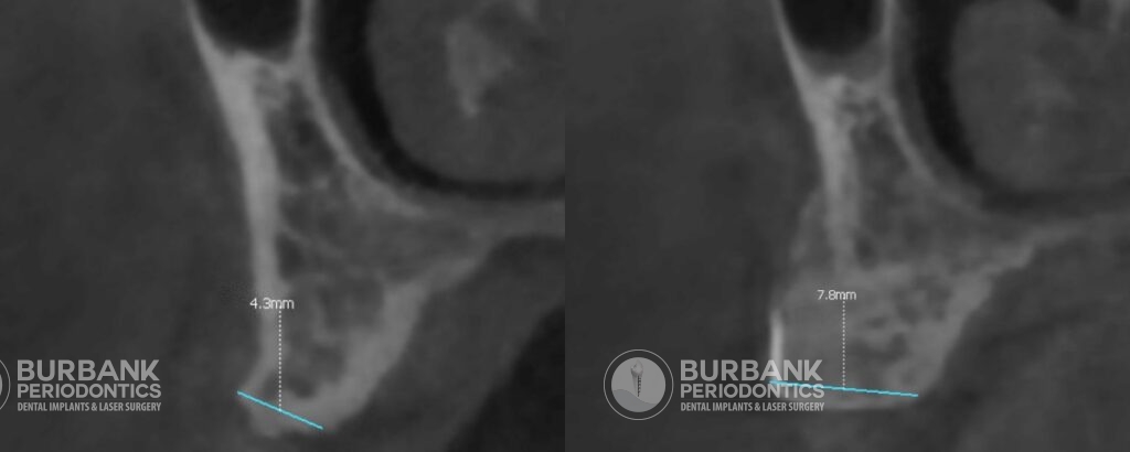 Ridge Augmentation | Burbank Periodontics